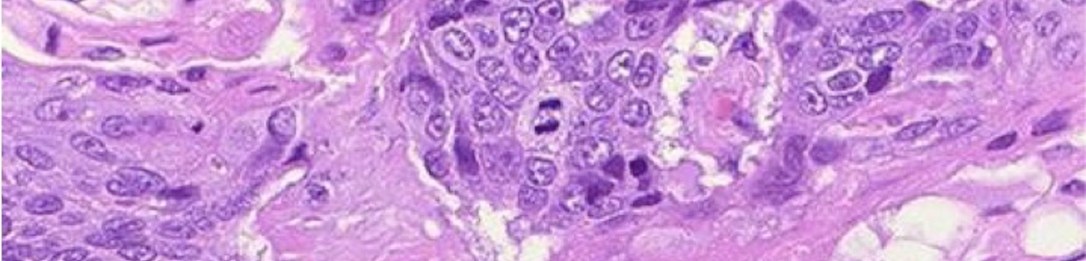 Causes Los Angeles CA, Oral Pathology Associates